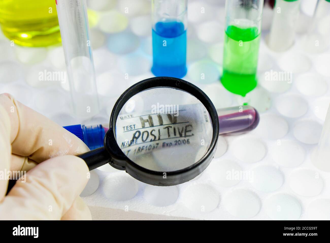 HIV blood test tube sample, aids immune viruses Stock Photo - Alamy