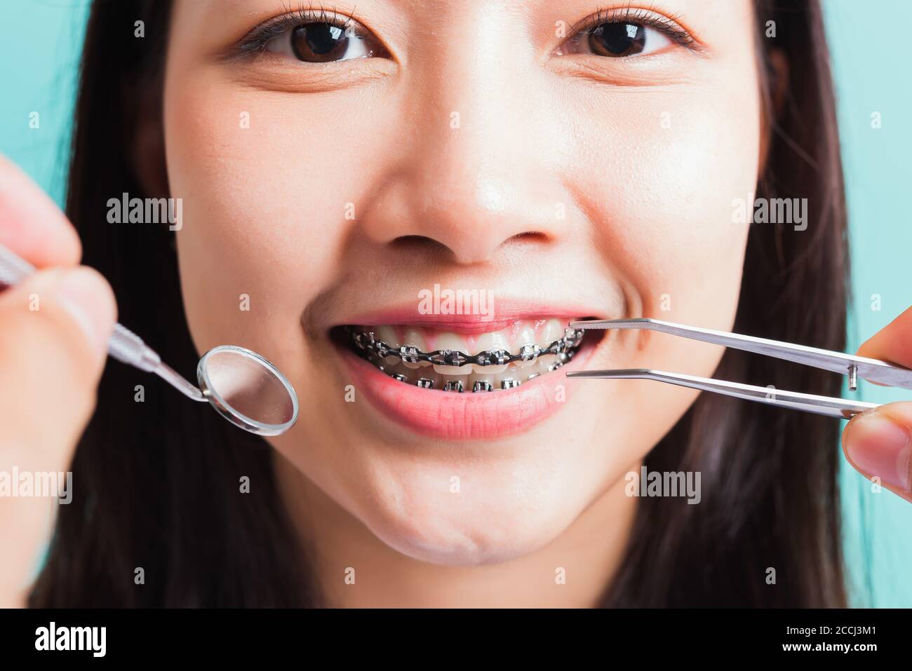 Asian teen beautiful young woman smile have dental braces on teeth ...