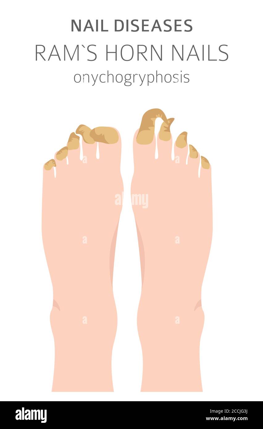 Nail diseases. Onychogryphosis, Ram`s horn nail. Medical infographic ...