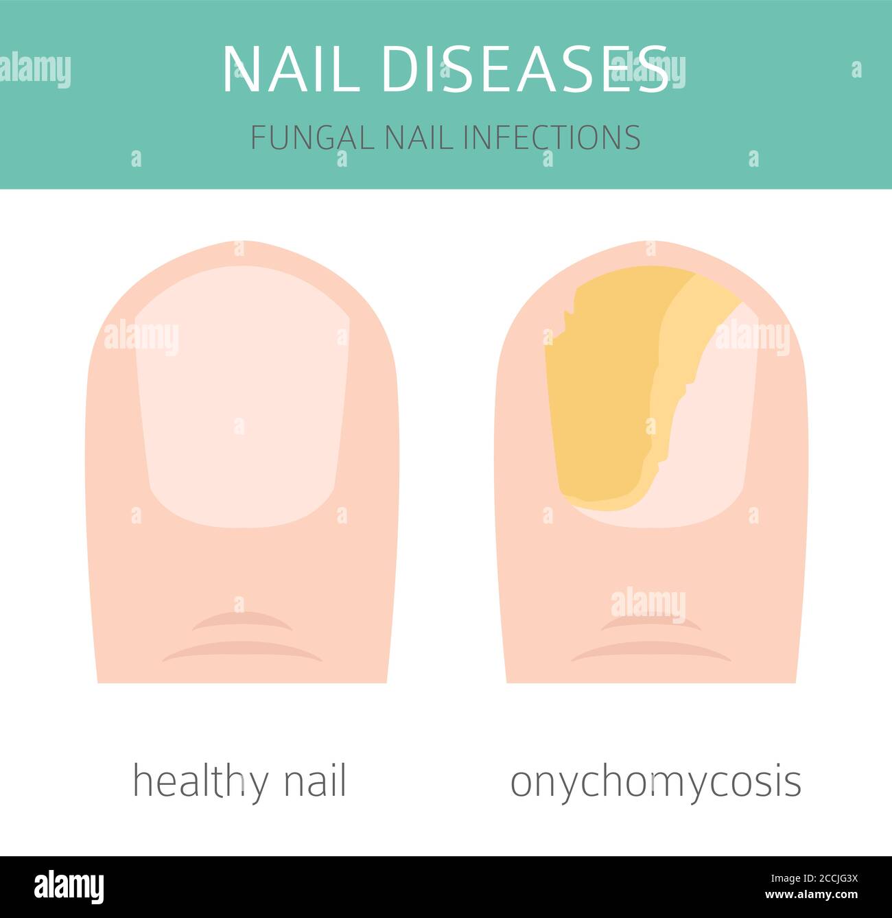Nail diseases. Onychomycosis, nail fungal infection causes, treatment ...