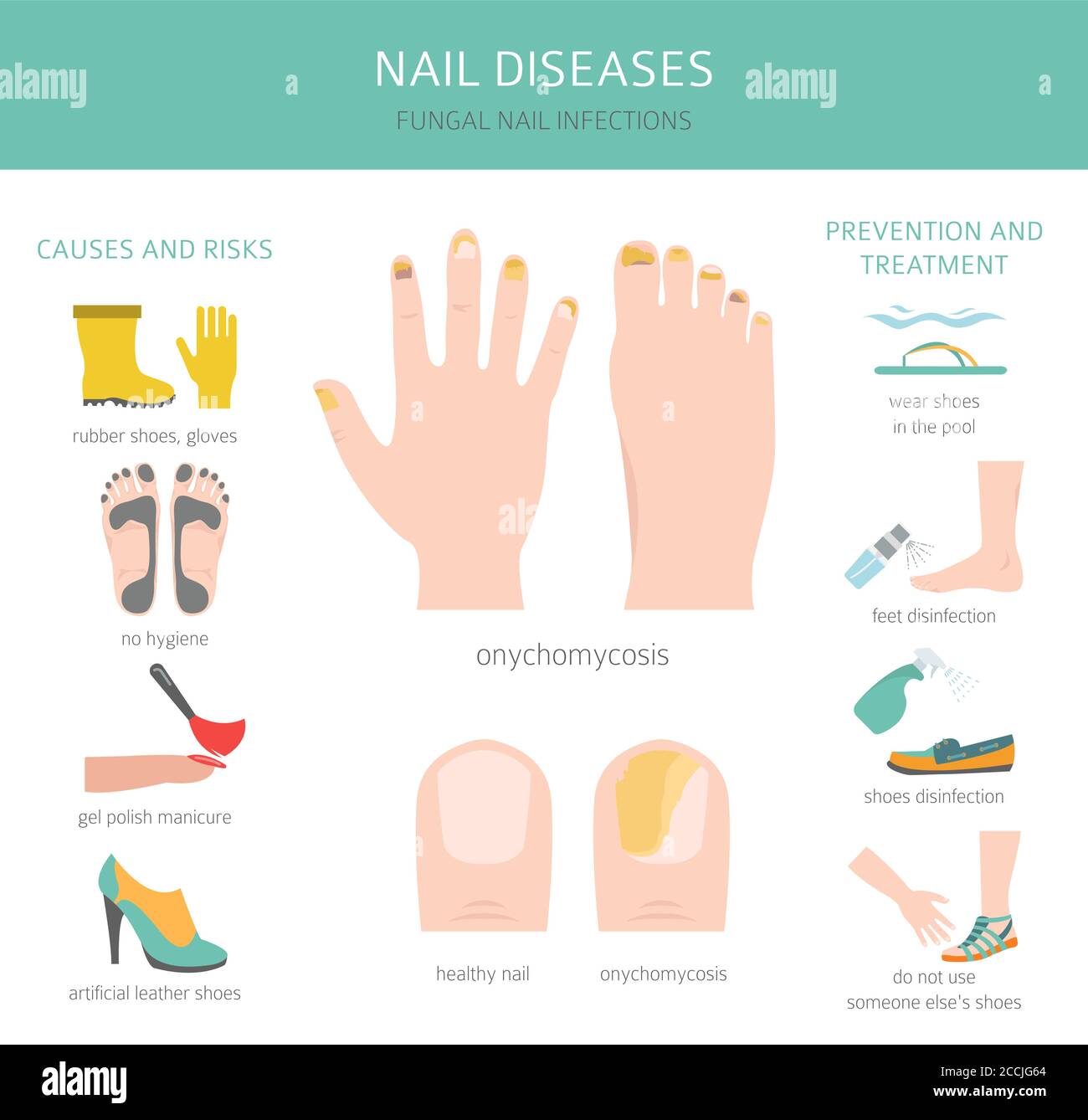 Nail diseases. Onychomycosis, nail fungal infection causes, treatment ...