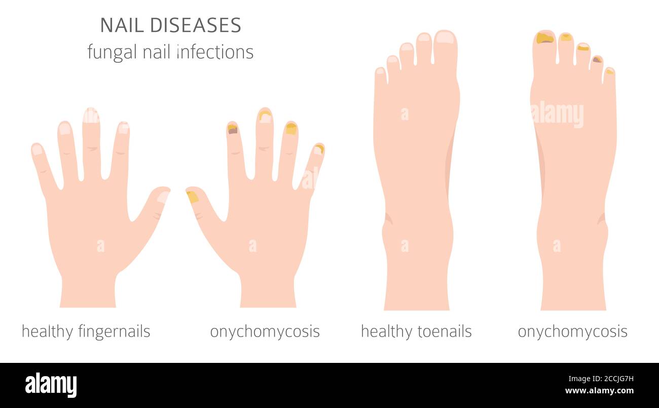 Nail diseases. Onychomycosis, nail fungal infection causes, treatment ...