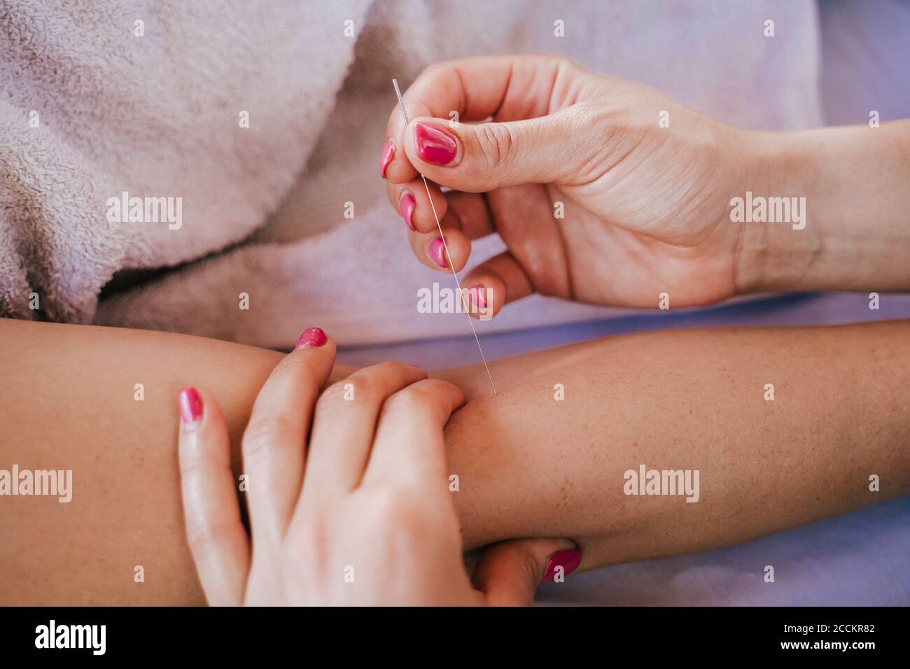 Inserting acupuncture needles hi-res stock photography and images - Alamy