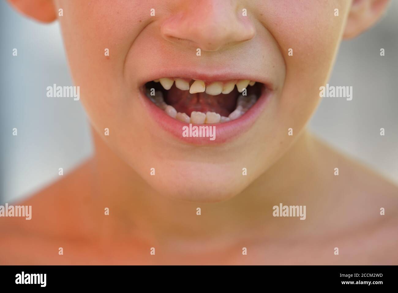 Boy with missing front teeth hi-res stock photography and images - Alamy