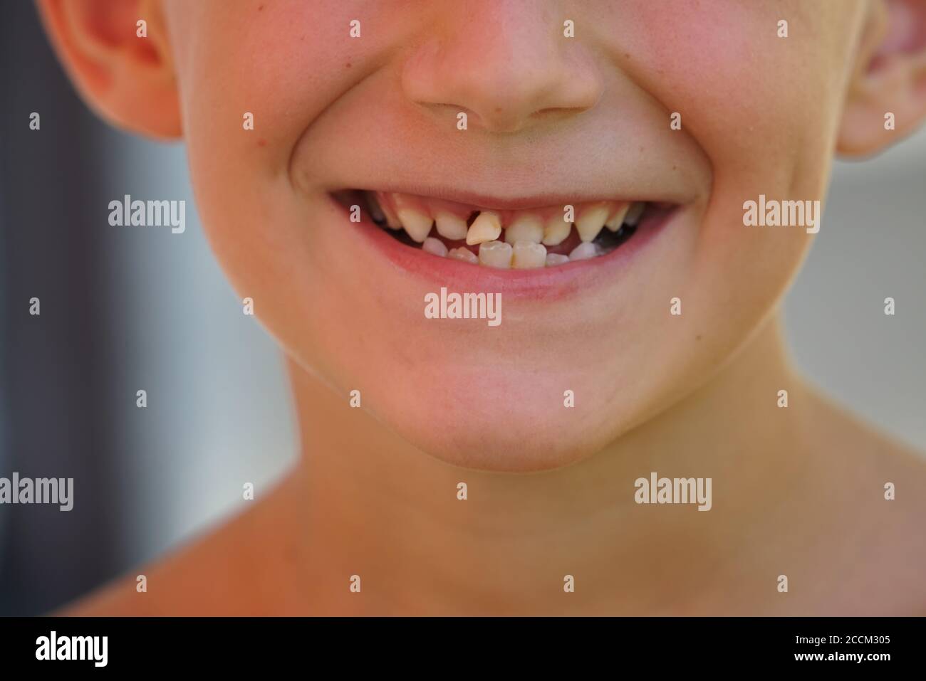 Milk tooth hi-res stock photography and images - Alamy