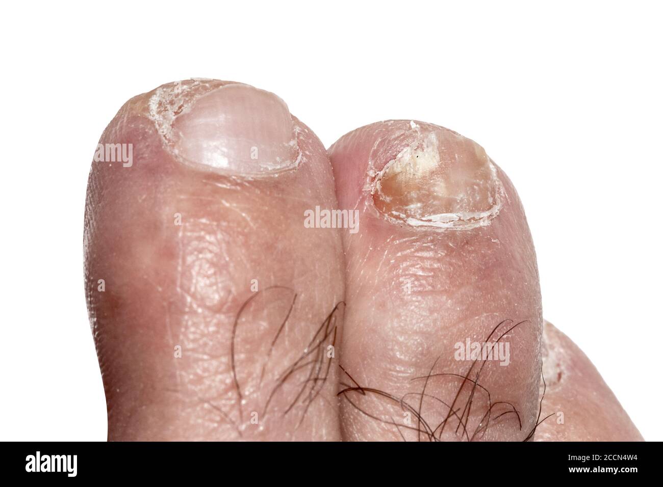 Macro photography of toe nails infected with Onychomycosis Stock Photo ...
