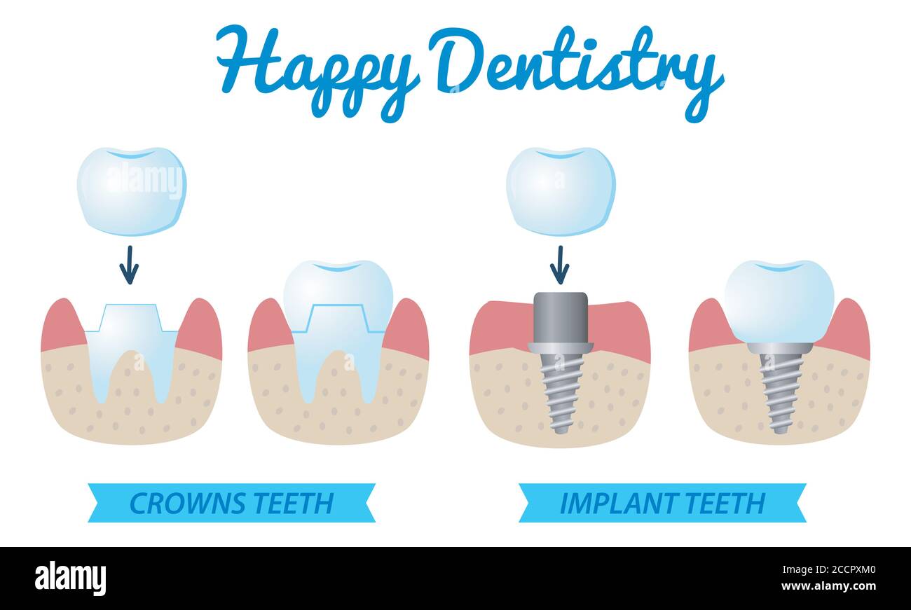 Happy dentistry poster. icons Installation of the crown on the tooth or ...