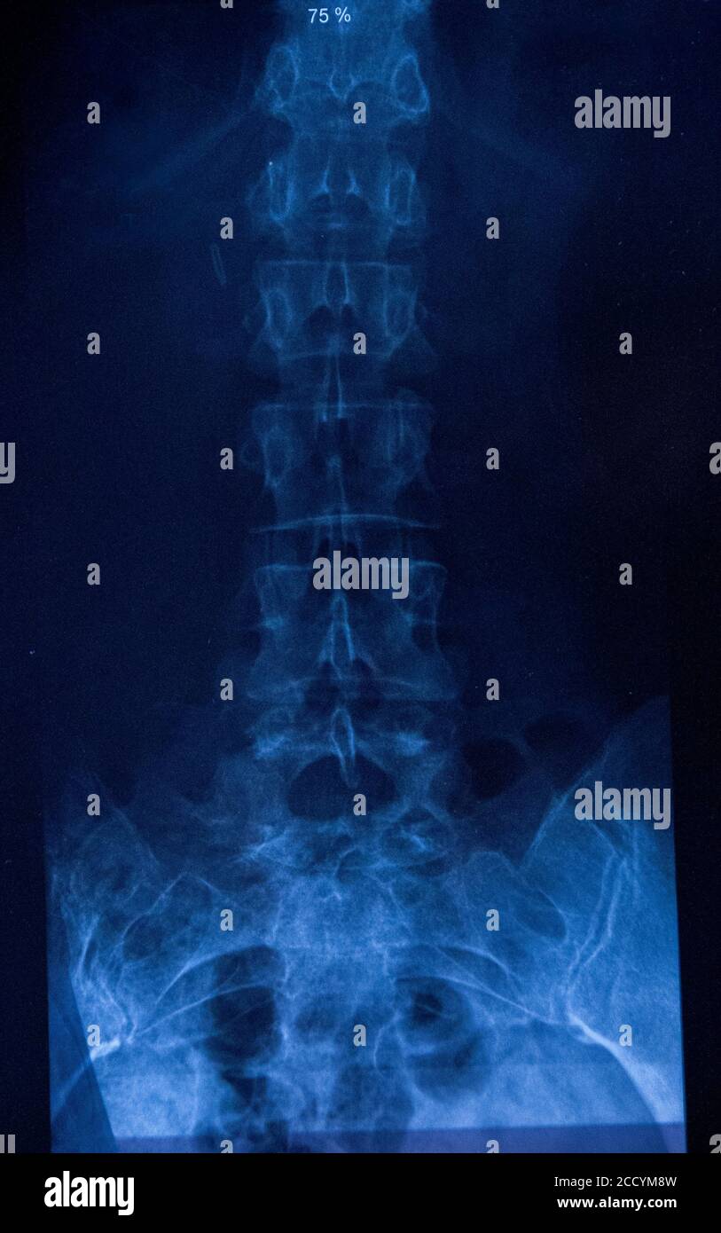 X ray of Vertebrae - Spinal column Stock Photo - Alamy