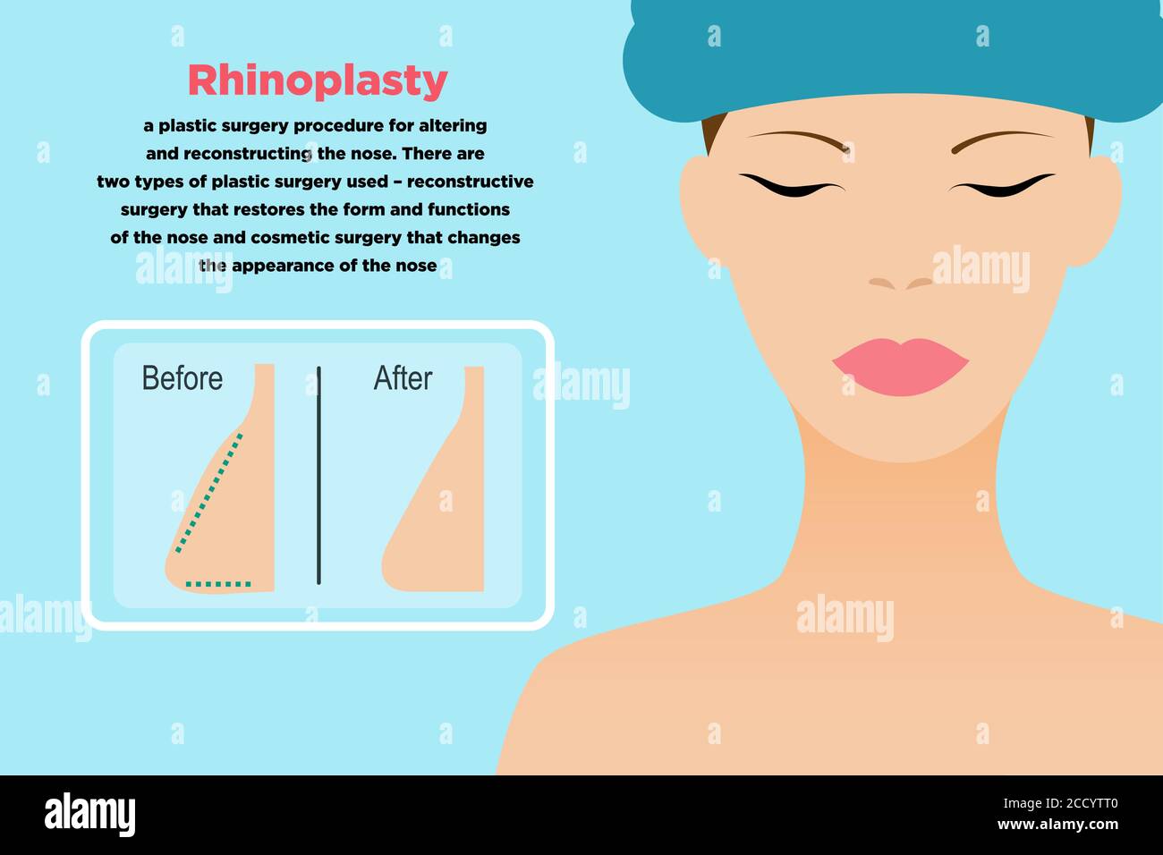 Rhinoplasty Vector template for posters and banners Stock Vector Image ...
