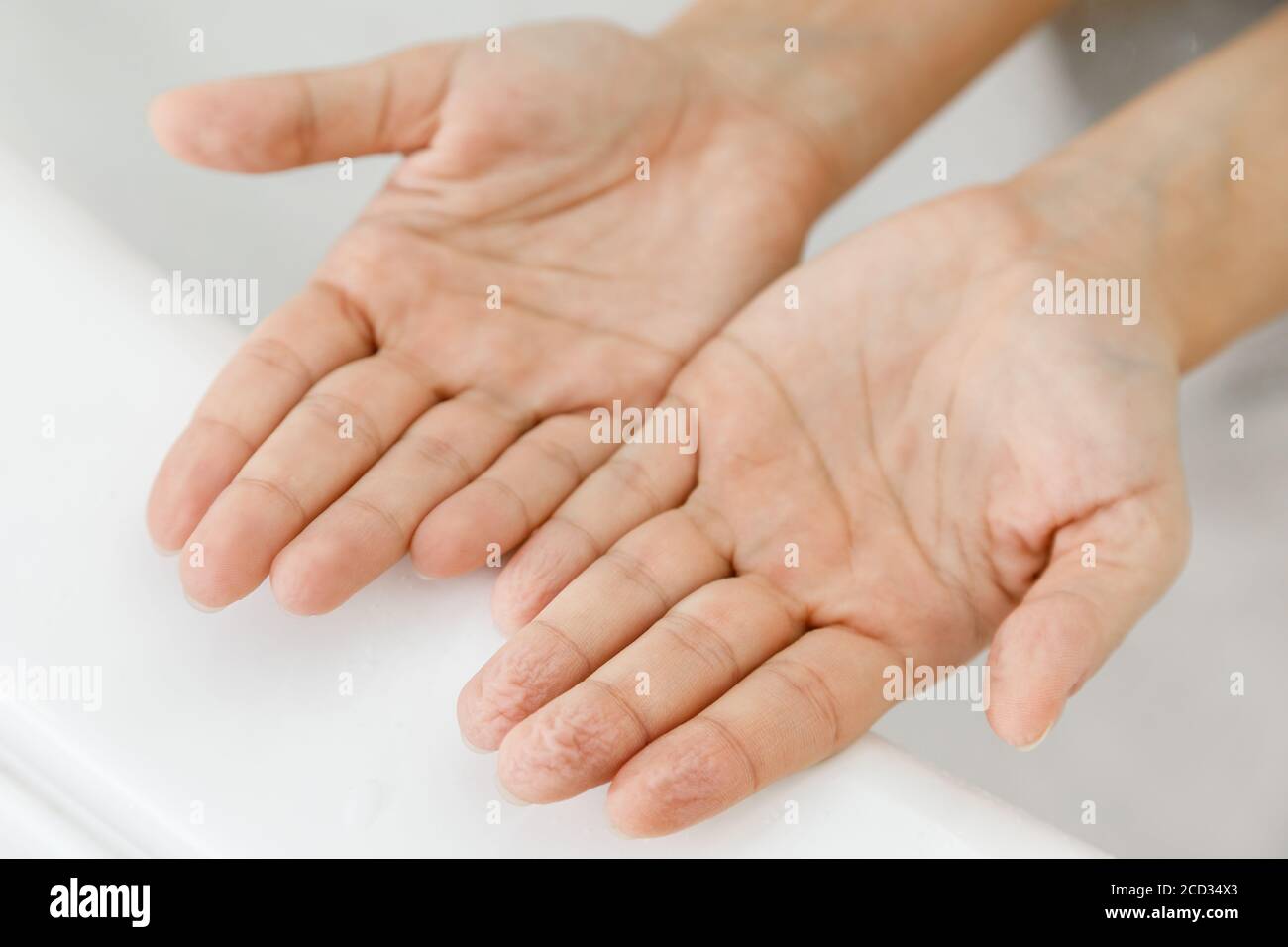 Comparision of female hands with wrinkles after bath Stock Photo - Alamy