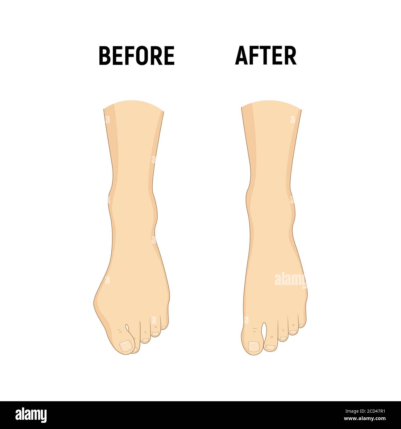 Hallux valgus, mild bunion correction. Vector illustration. Medical ...