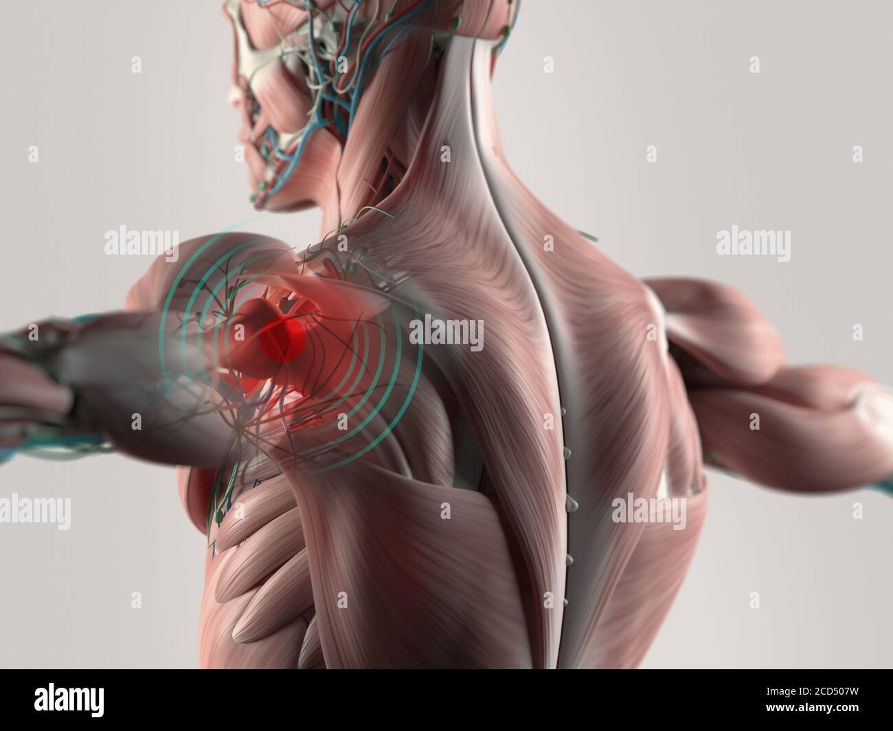 Medical illustration of injured shoulder Stock Photo - Alamy