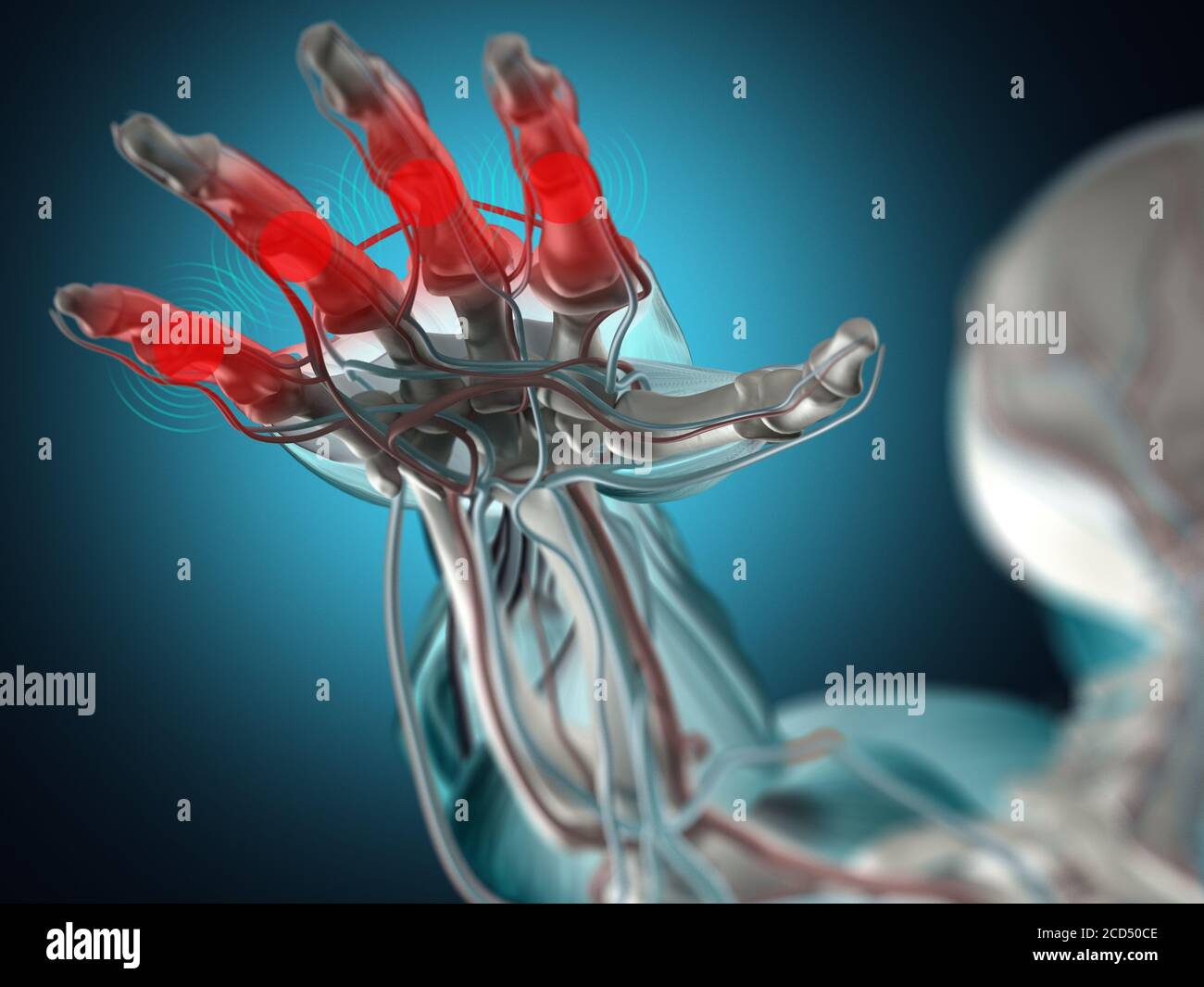 Arthritis in fingers or hand. Anatomy 3D illustration Stock Photo - Alamy