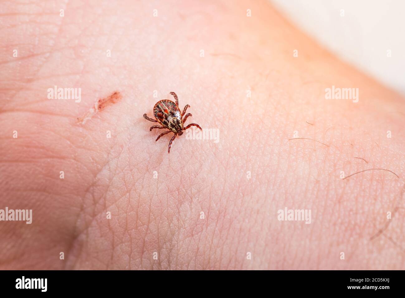 Parasitic mite infection of the skin hi-res stock photography and ...