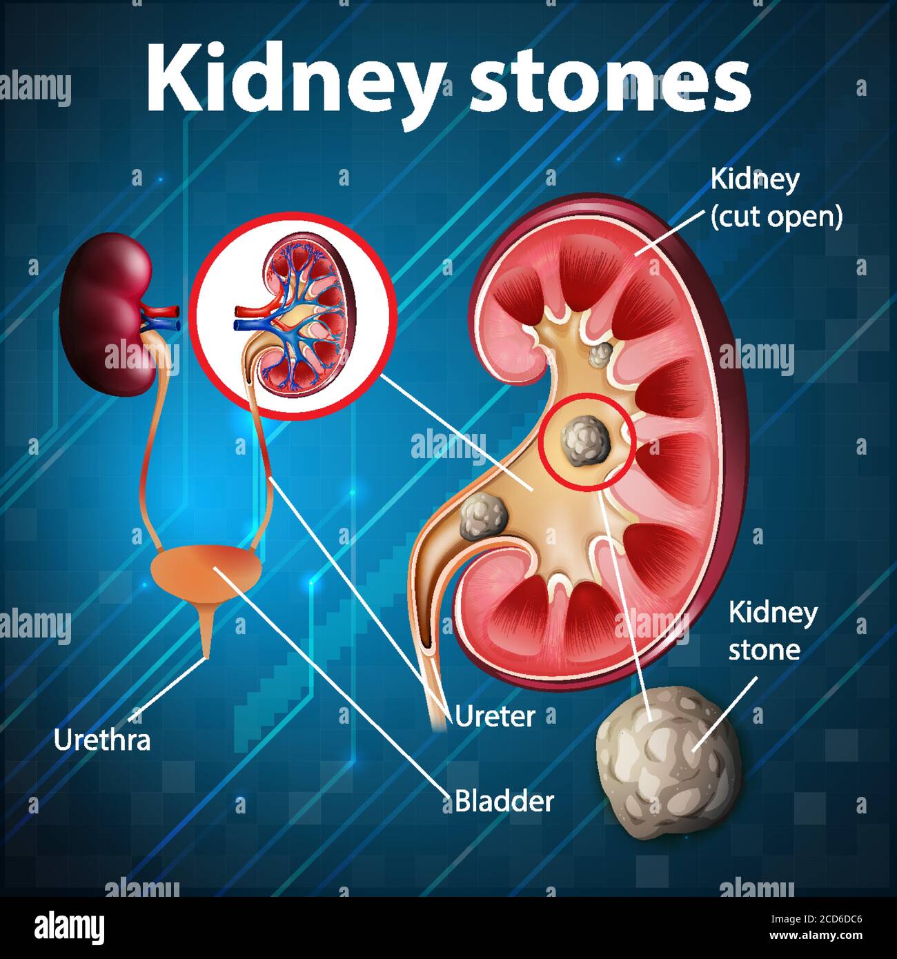 Kidney stones medical image Stock Vector Images - Alamy