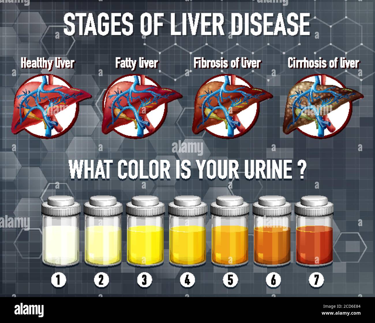 Stages of liver disease illustration Stock Vector Image & Art - Alamy
