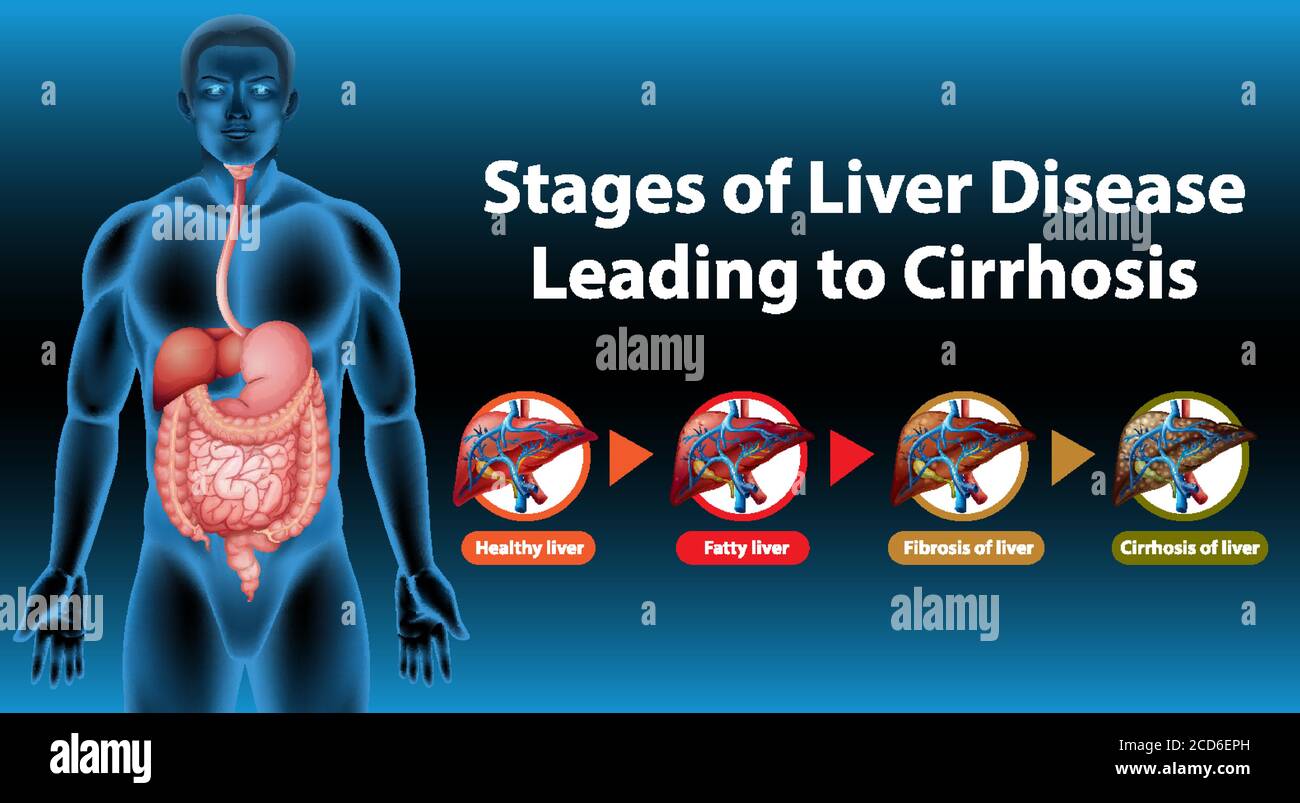Liver Cirrhosis Drawing High Resolution Stock Photography and Images ...