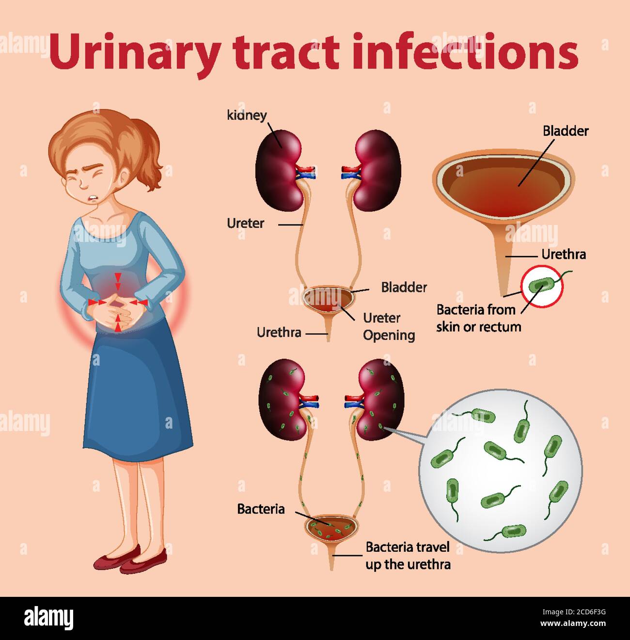 Informative illustration of urinary tract infections illustration Stock ...