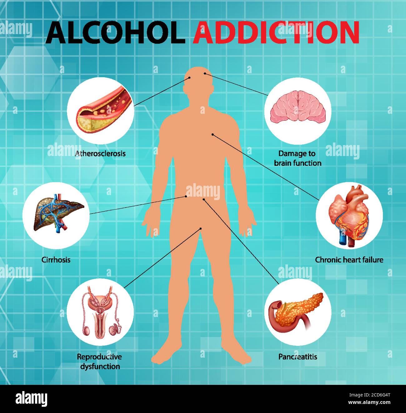 Alcohol addiction or alcoholism information infographic illustration ...
