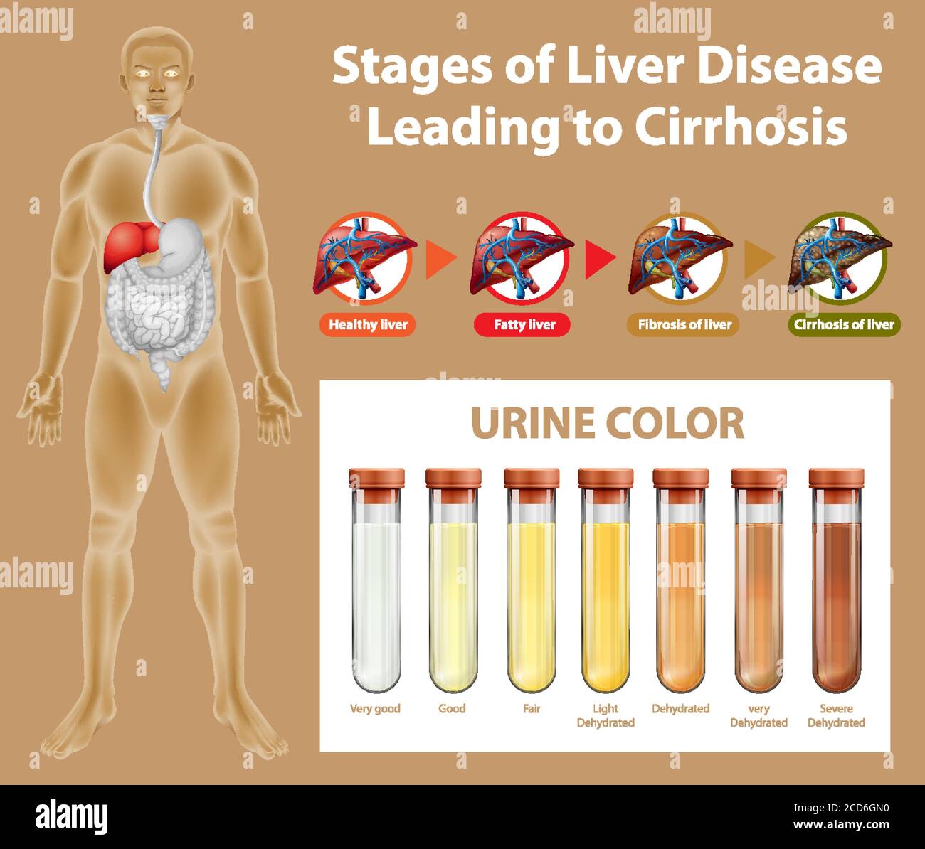 Stages of liver disease leading to Cirrhosis illustration Stock Vector ...