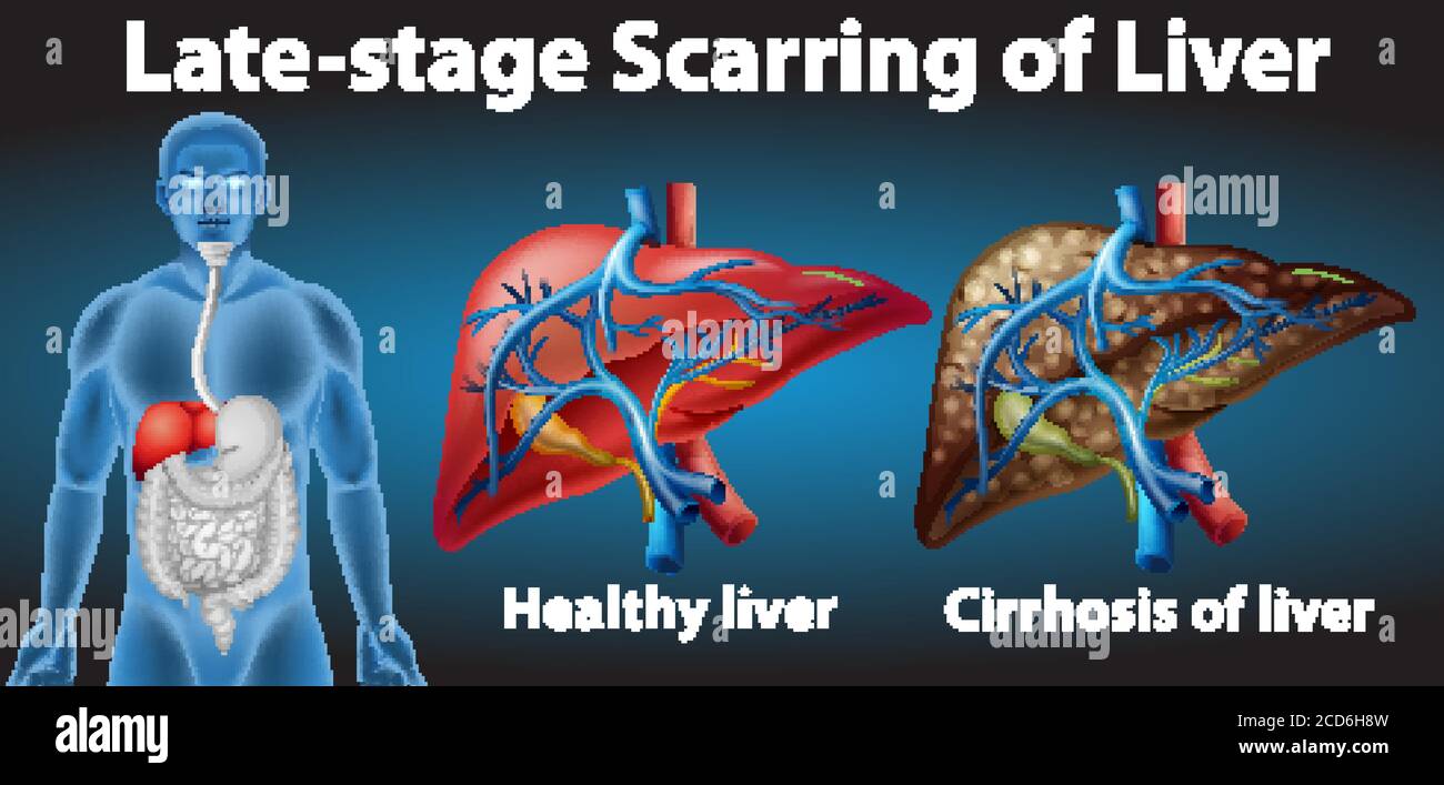 Late-stage scarring of liver illustration Stock Vector Image & Art - Alamy