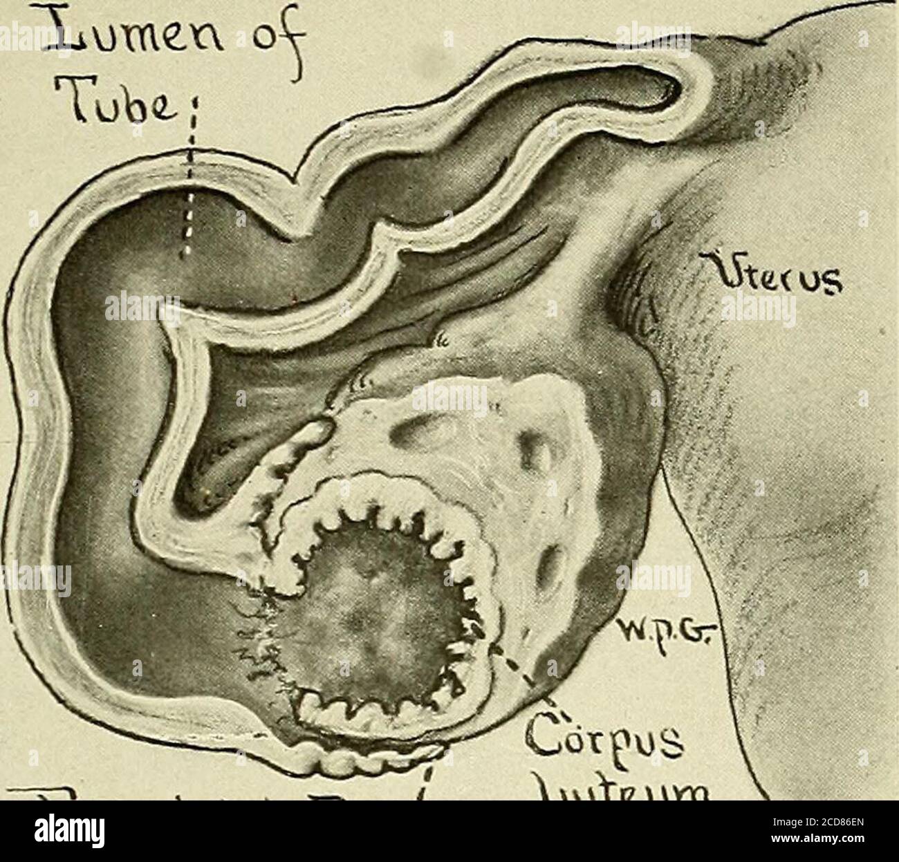 . Gynecology : . Fig. 36.—Acute Purulent Salpingitis. The tubes are ...