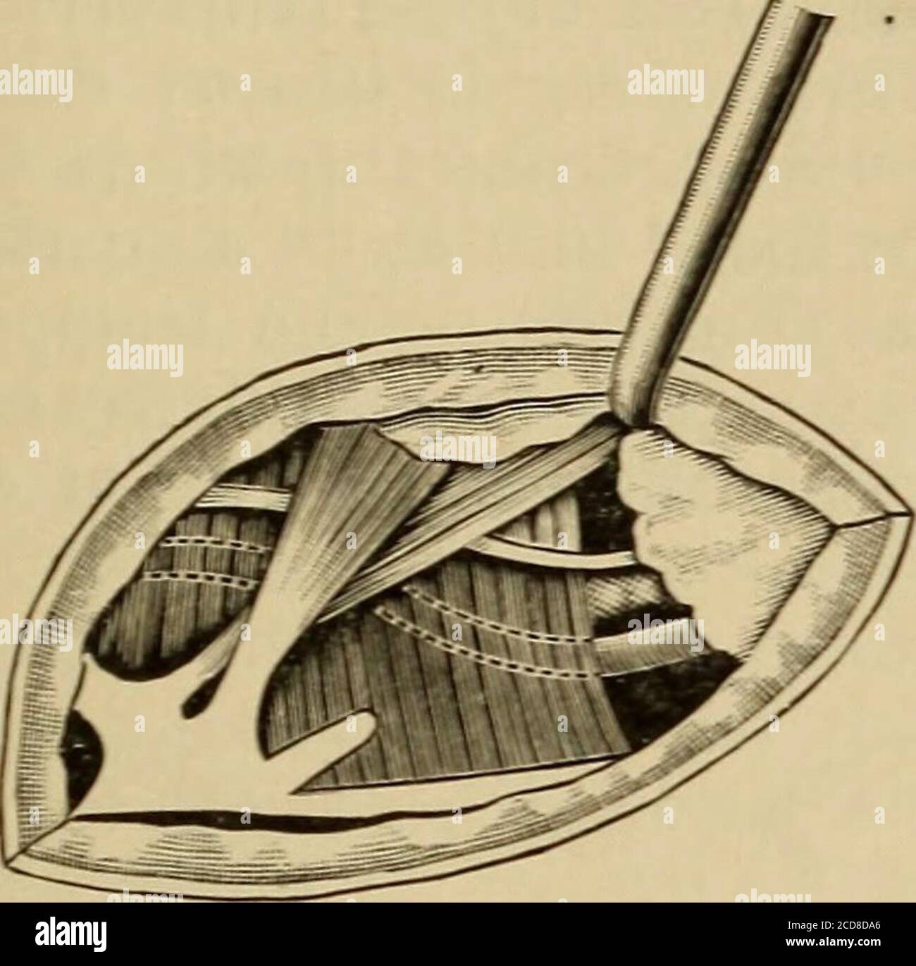 Lingual Artery Ligation