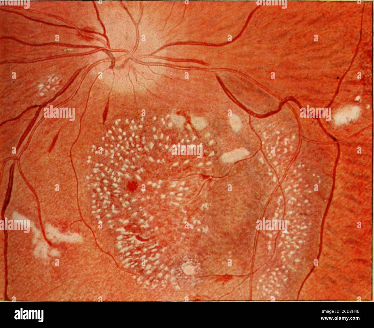 . Transactions . Fm. 1.. Firt. 2. .Iillard f Son, Imp. TUBERCULOSIS Ol ...