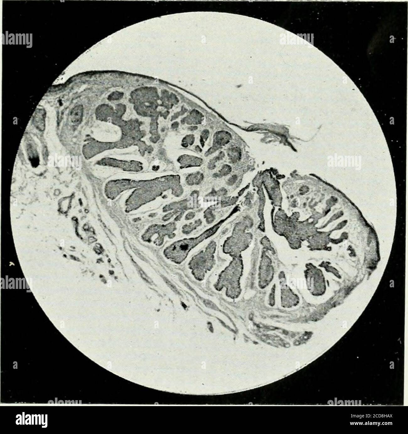Rodent ulcer High Resolution Stock Photography and Images - Alamy