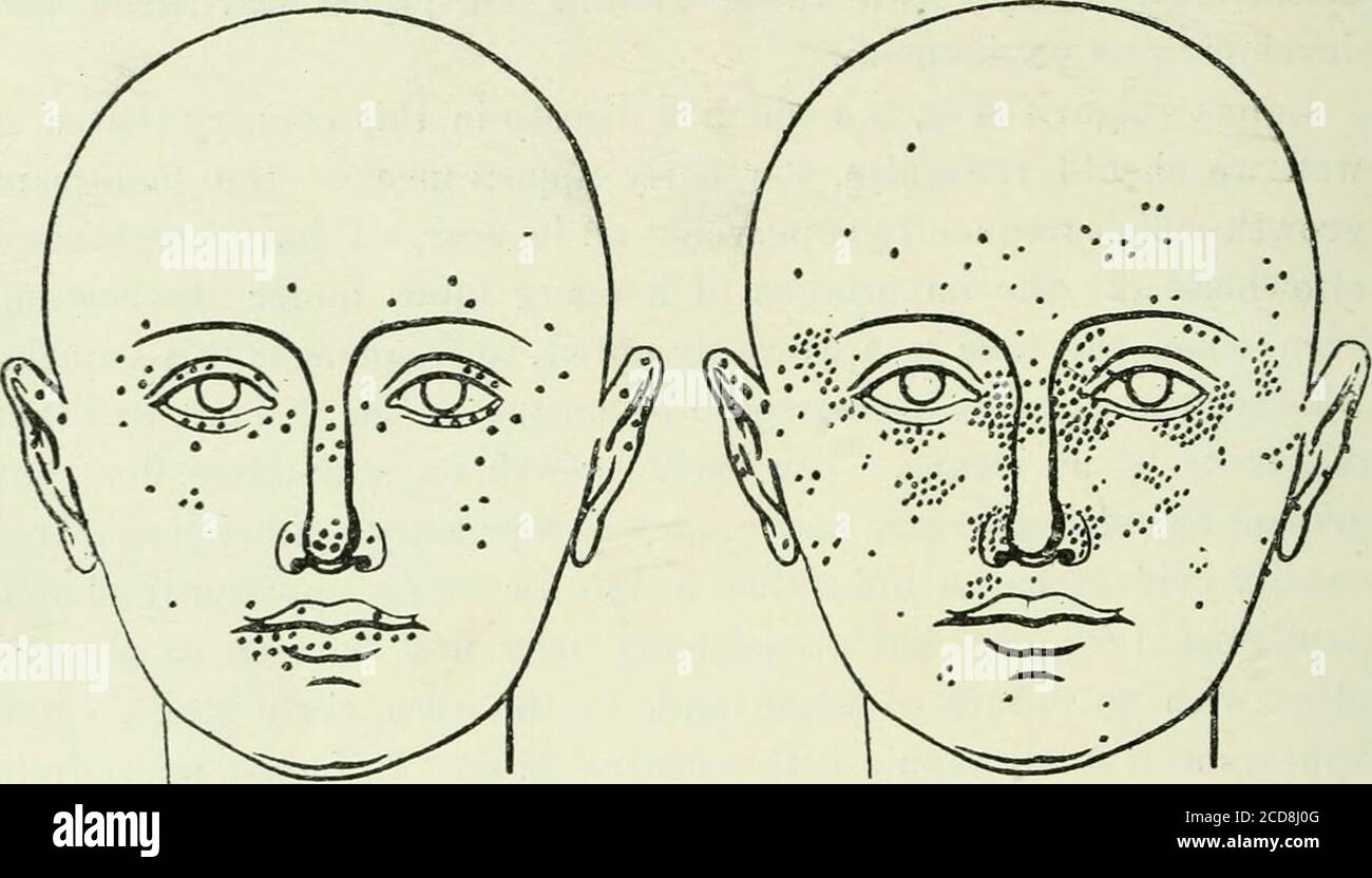 Scar on the right cheek hi-res stock photography and images - Alamy