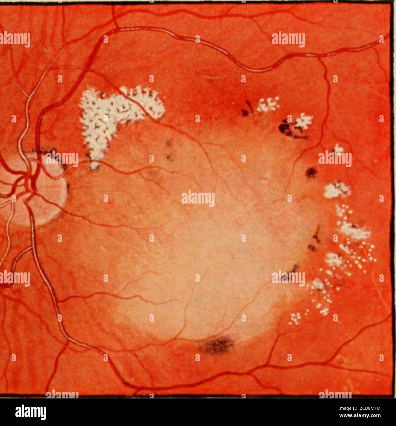 Varicose vein eye hi-res stock photography and images - Alamy