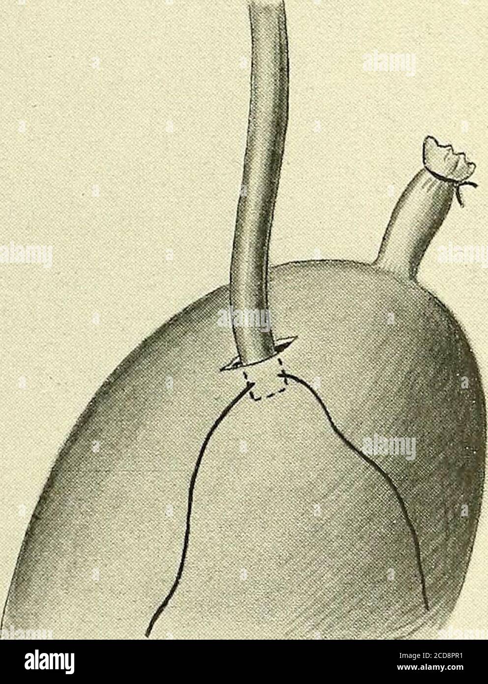 . Surgery, its principles and practice . Fig. 139.—Implantation of ...