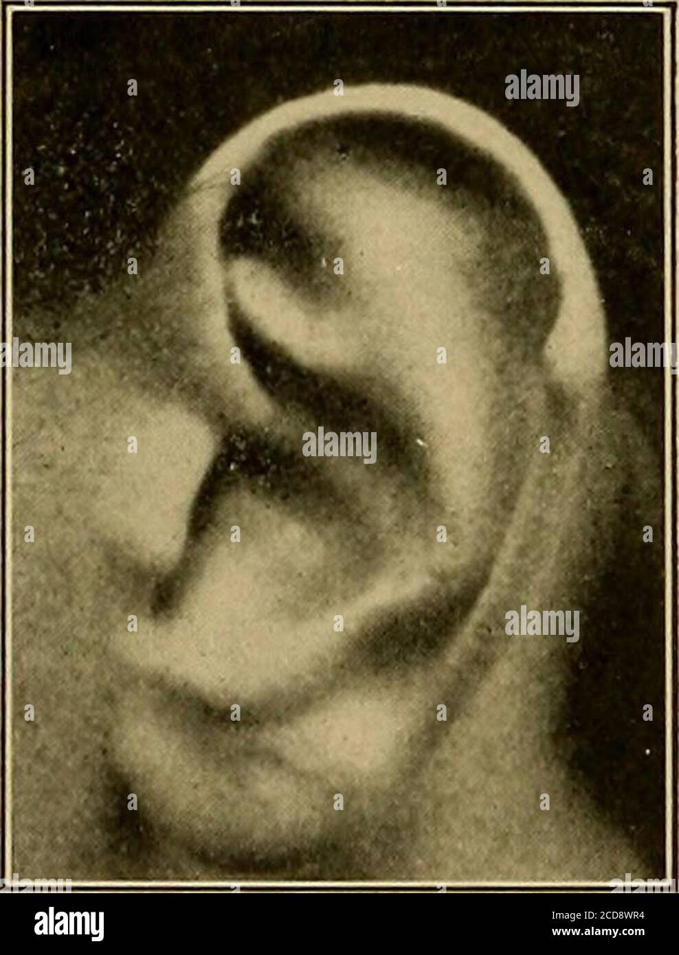 Tophus hi-res stock photography and images - Alamy Tophus hi-res stock photography and images - Alamy