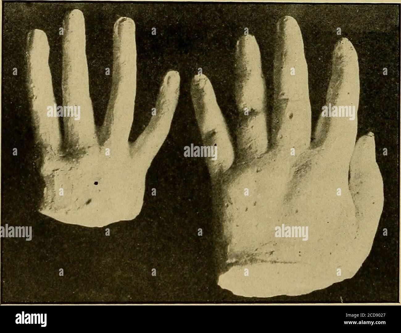 Polyarticular hi-res stock photography and images - Alamy