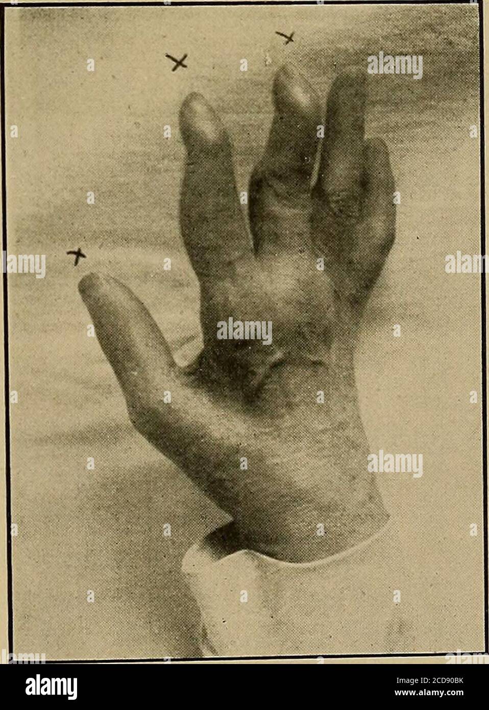 . Physical diagnosis . Fig. 257.—Atrophic Arthritis. Early stage.. Fig ...