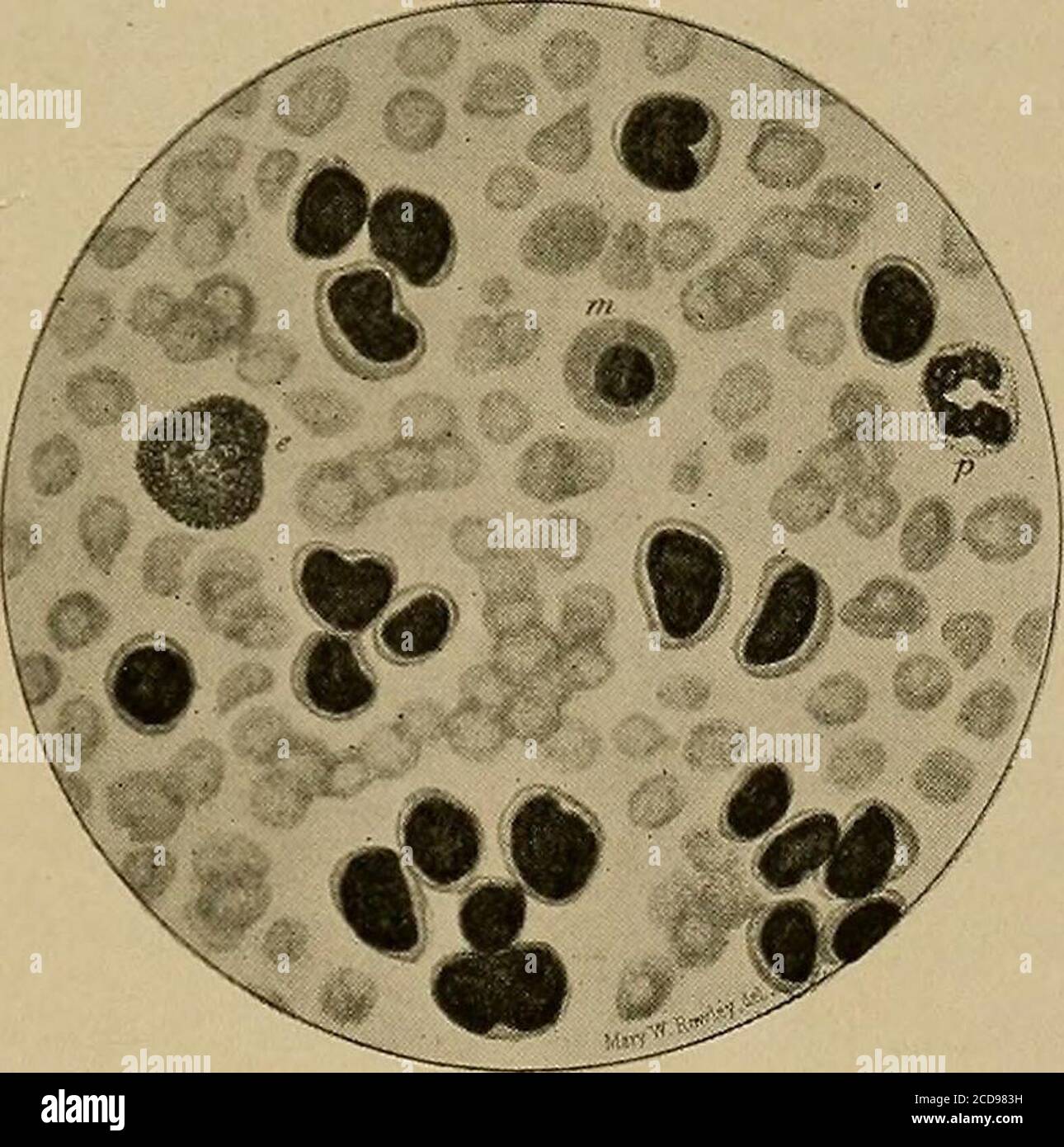 . Physical diagnosis . Fig. 246.—a, Leucocytosis (40,000); sixteen ...