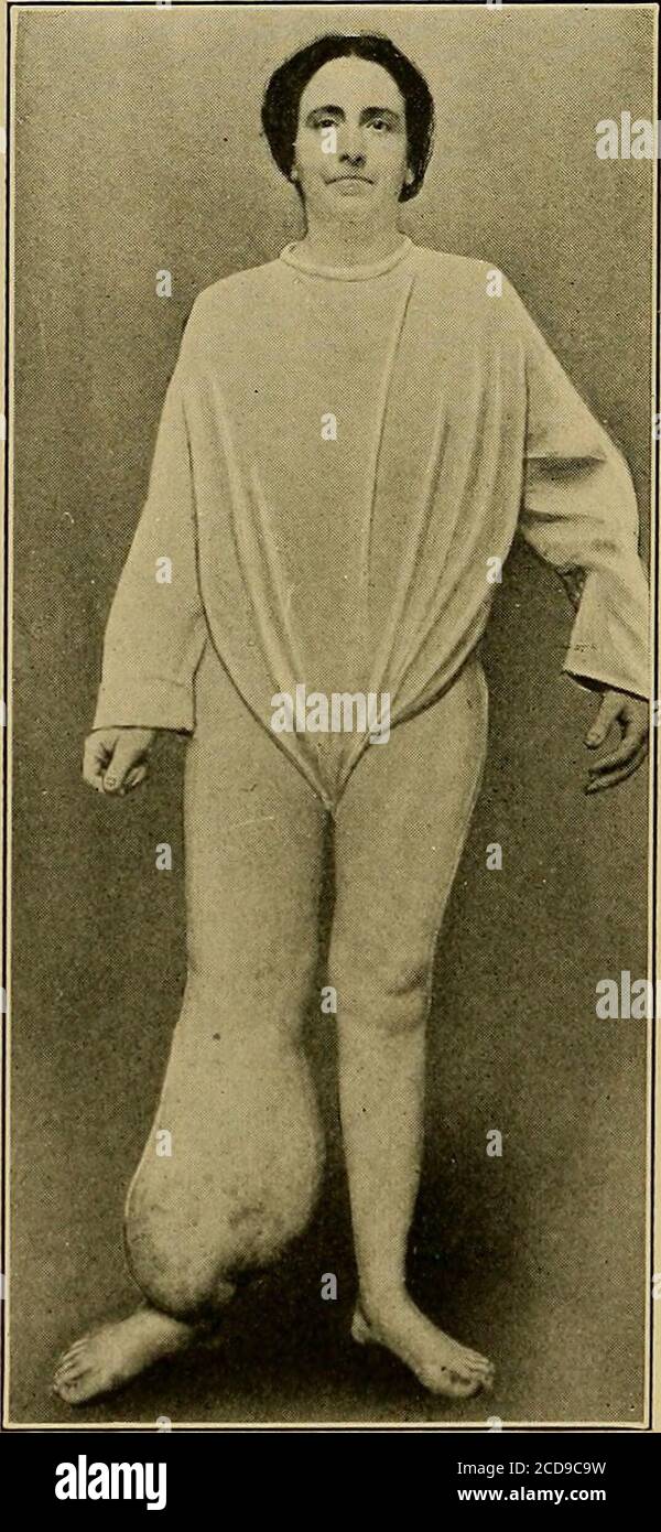 . Physical diagnosis . Fig. 236.—Angioneurotic oedema of legs. 5 ...