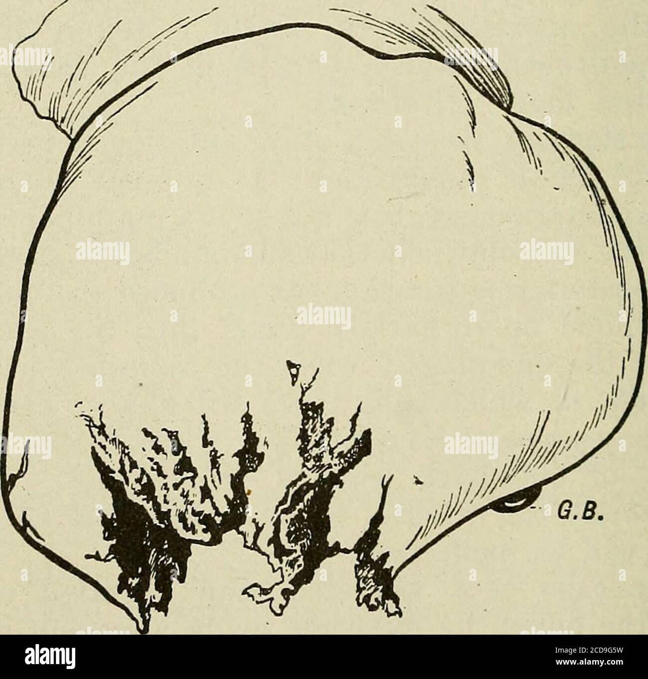 Septic Wounds High Resolution Stock Photography and Images - Alamy