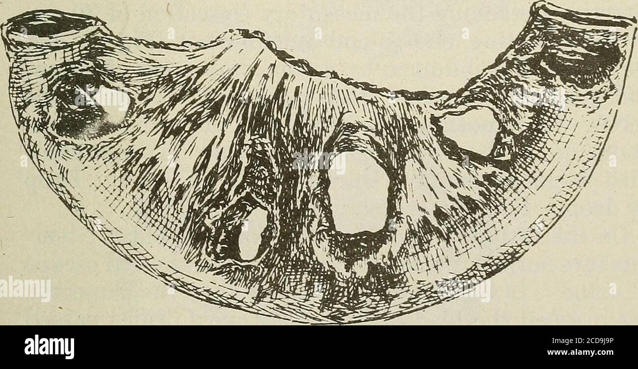 . Medical and surgical therapy . Fig, 9.—^Loops of the small intestine ...
