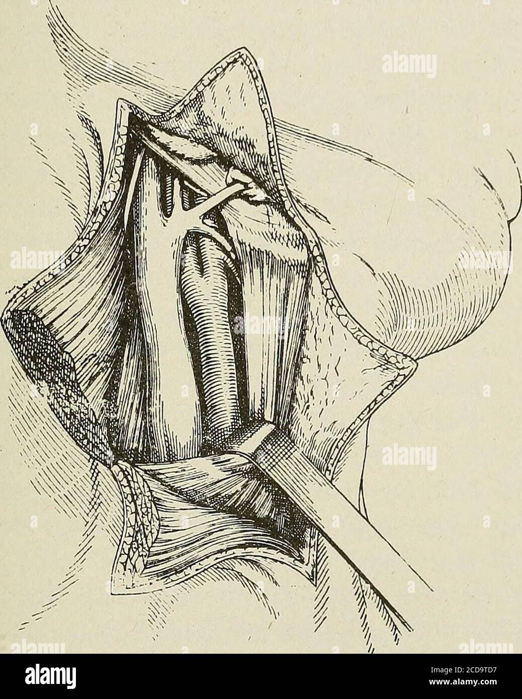 Cervical incision hi-res stock photography and images - Alamy