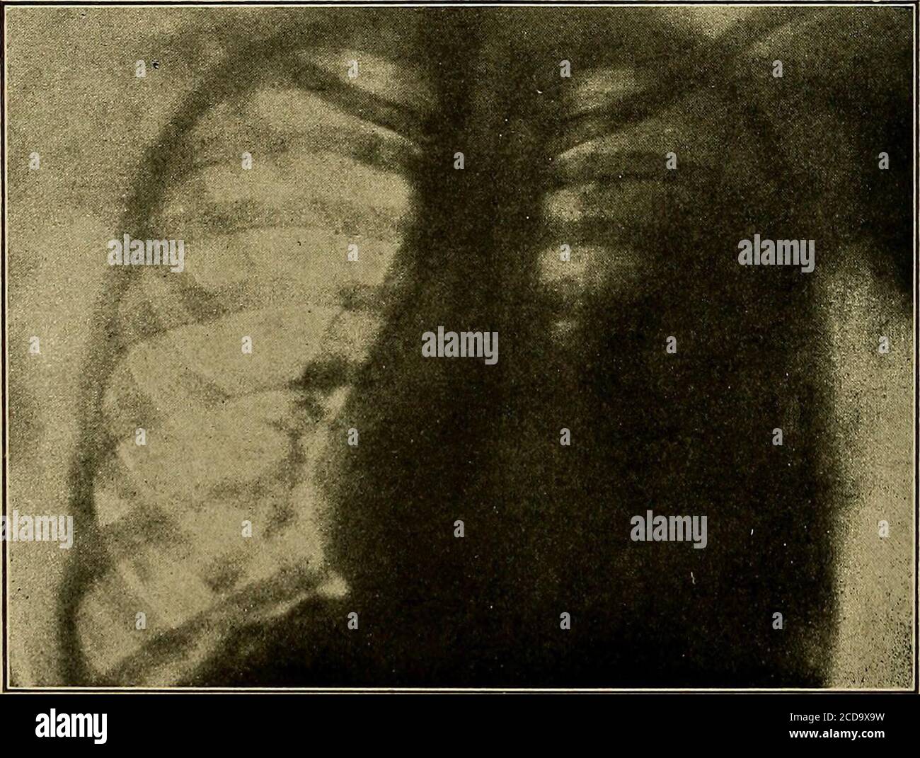 . Physical diagnosis . ffusions.—Three zones of resonance can often ...