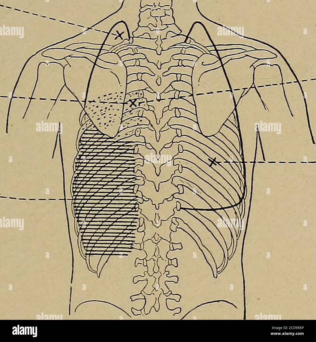 Pleural lung collapse hi-res stock photography and images - Alamy