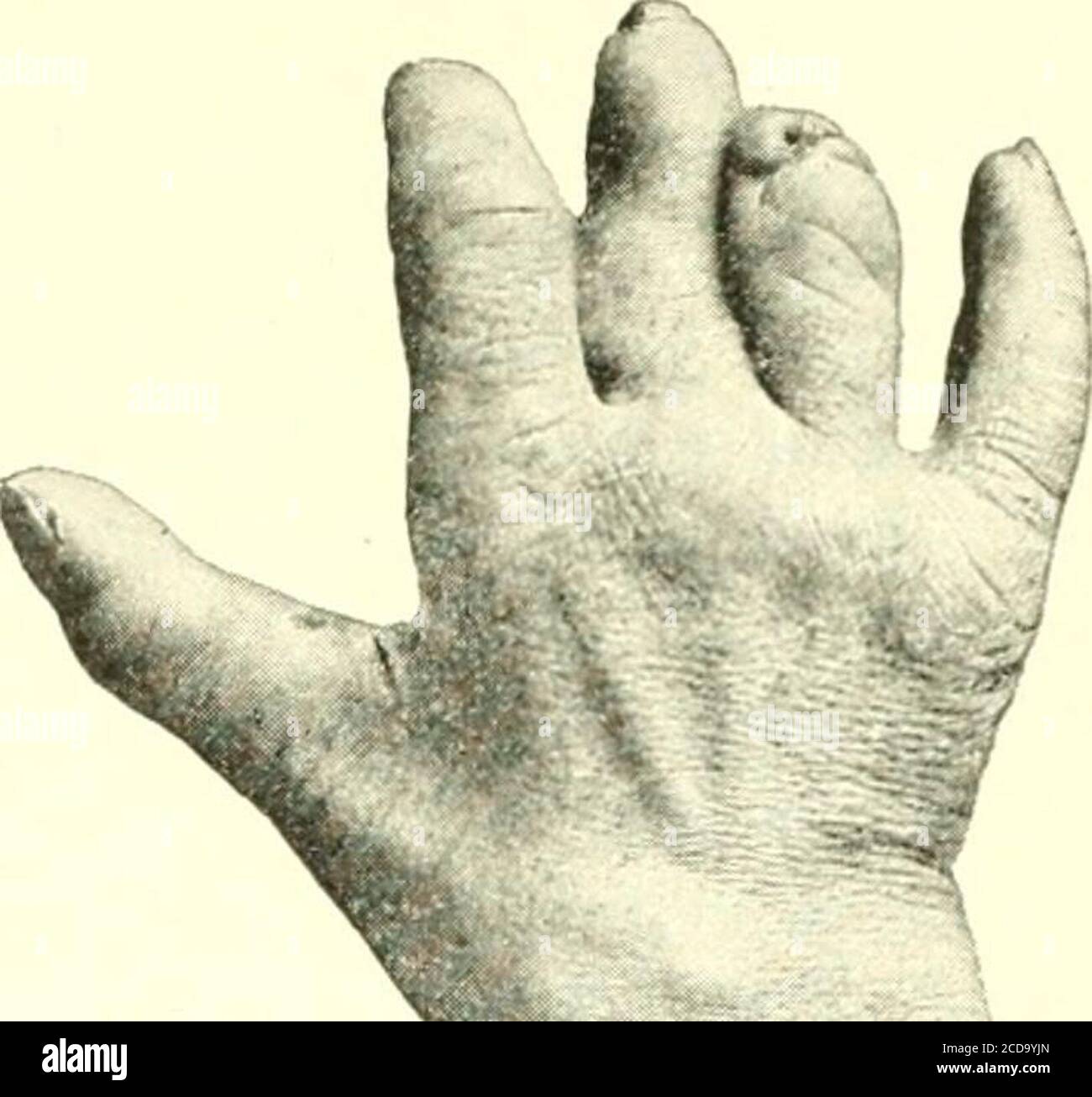 Phlegmon hi-res stock photography and images - Alamy