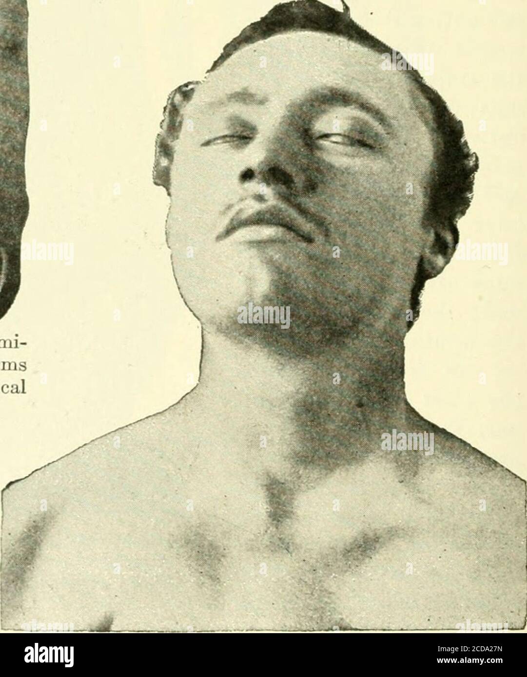 . A text-book of medicine for students and practitioners . Fig. 183 ...