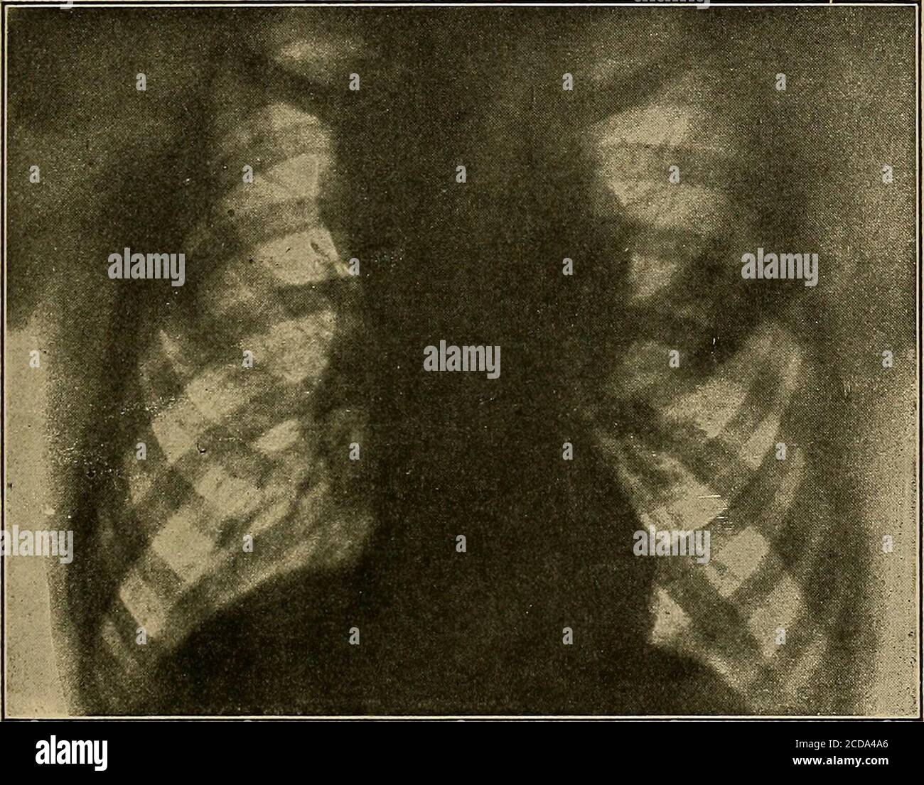 . Physical diagnosis . Fig. 177.—Radiograph of Case whose Photograph is ...