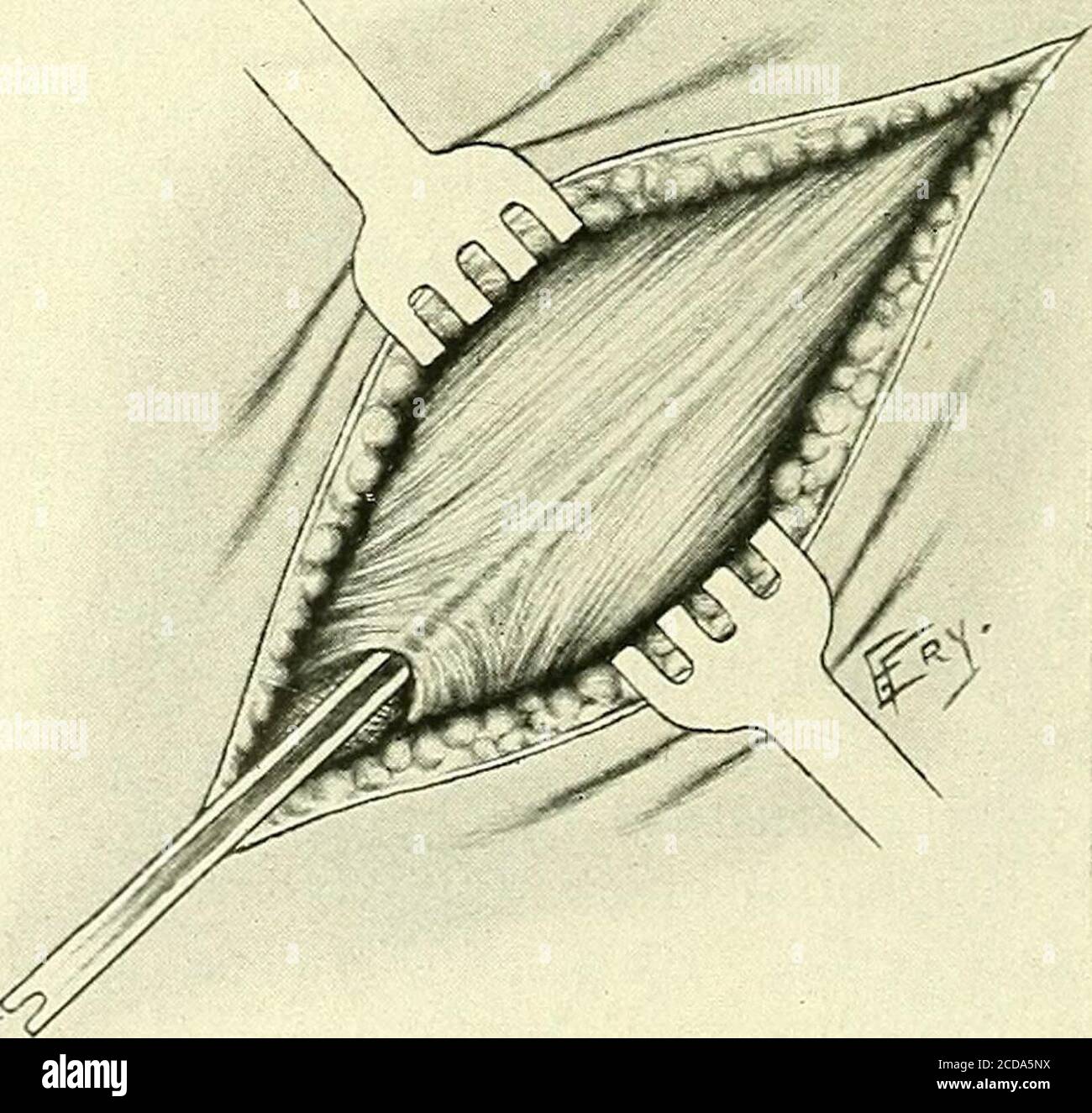 . Surgery, its principles and practice . ofthe sac; ligation of the sac ...