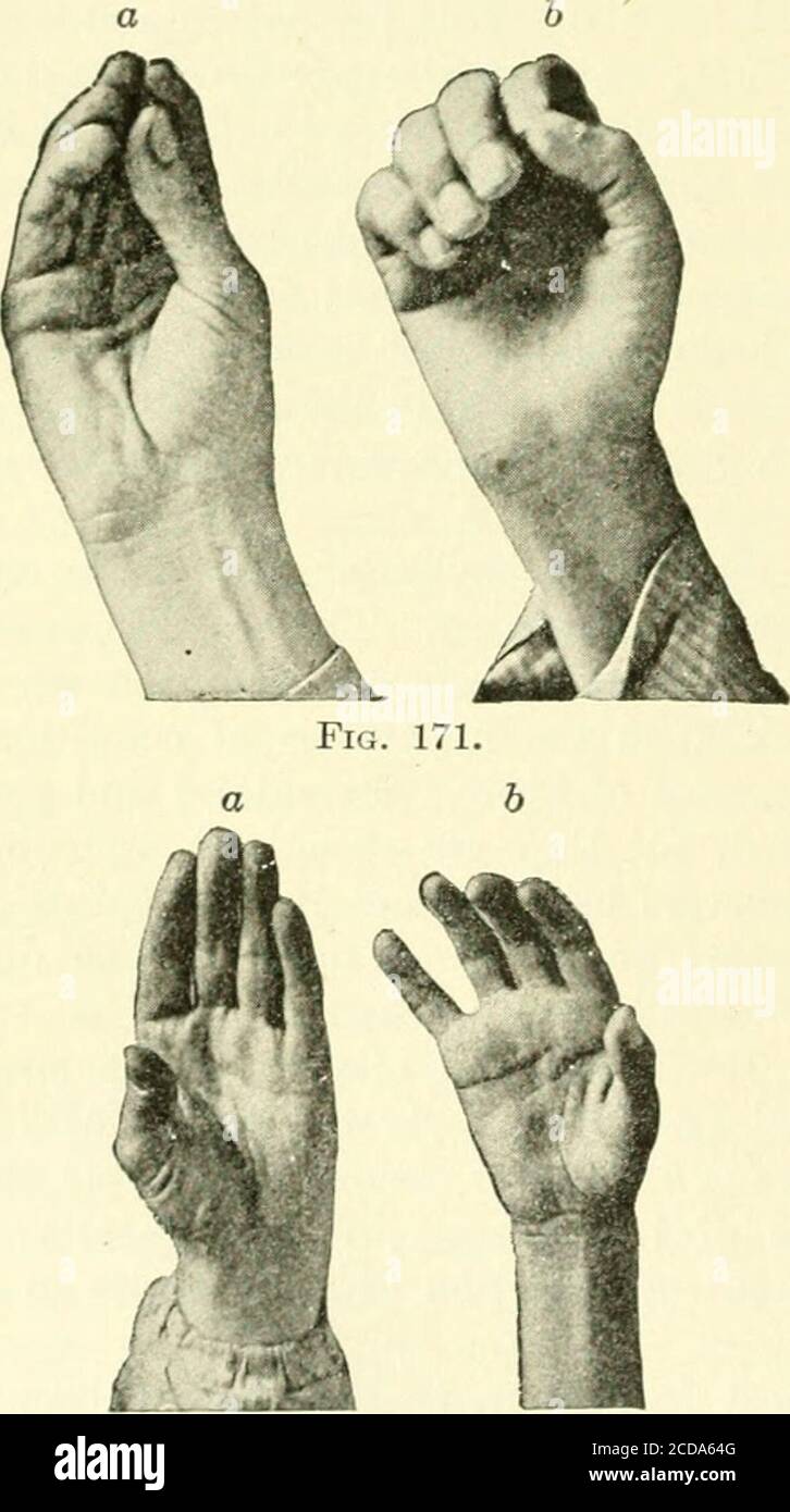 Atrophied hand hi-res stock photography and images - Alamy