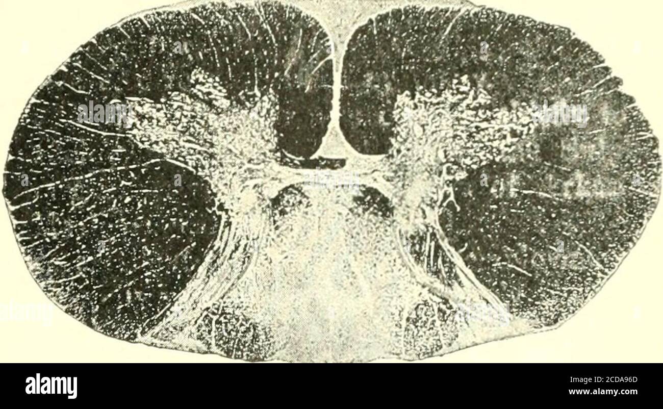 Tabes Dorsalis Spinal Cord