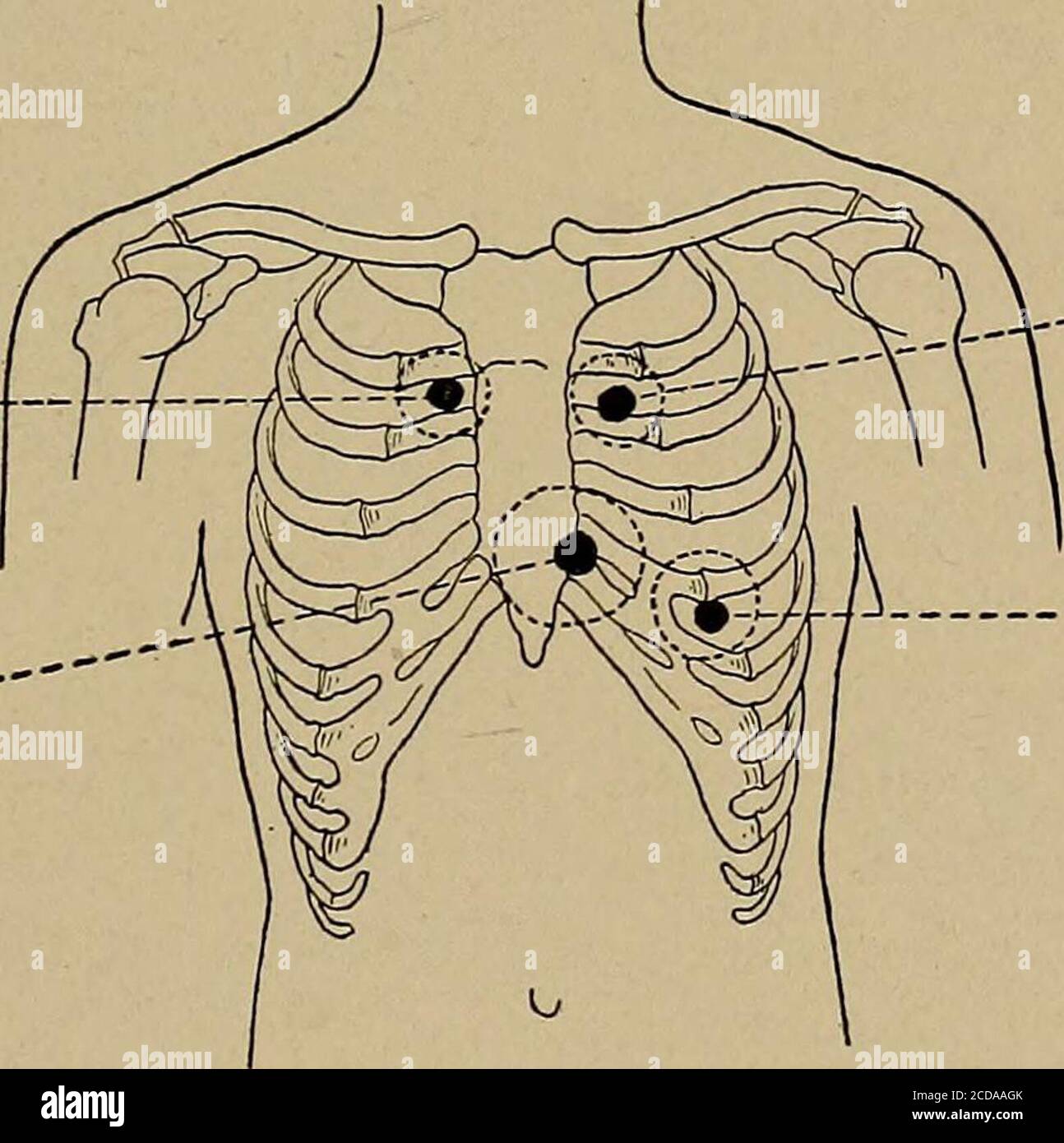 Pyothorax Without Fistula Chest Drains Physiopedia