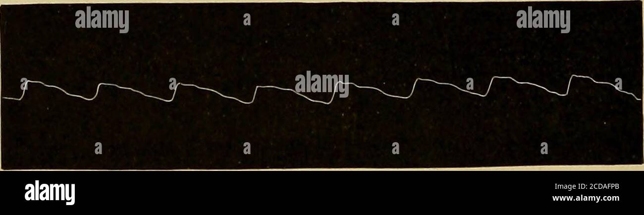 . Physical diagnosis . Fig. 90.-—Sphygmographic Tracing of Low Tension ...